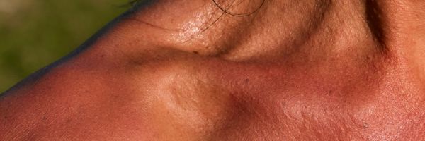 Sun-Damaged Skin? How to Repair and Rejuvenate After Summer - #1 ...